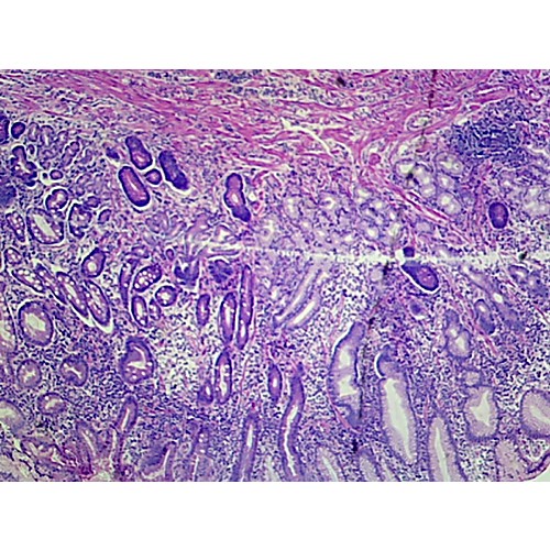 Prepared Microscope Slide,Gastric Ulcer Human