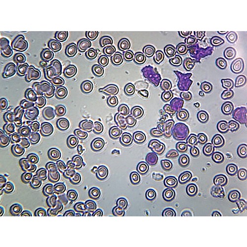 Prepared Microscope Slide,Acute Lymphatic Leukemia Smear