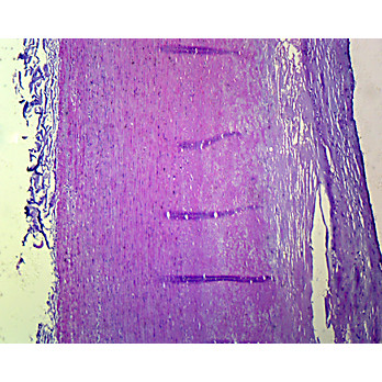 Prepared Microscope Slide,Atherosclerosis Human Coronary Artery