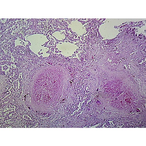 Prepared Microscope Slide,Lung Tuberculosis Human